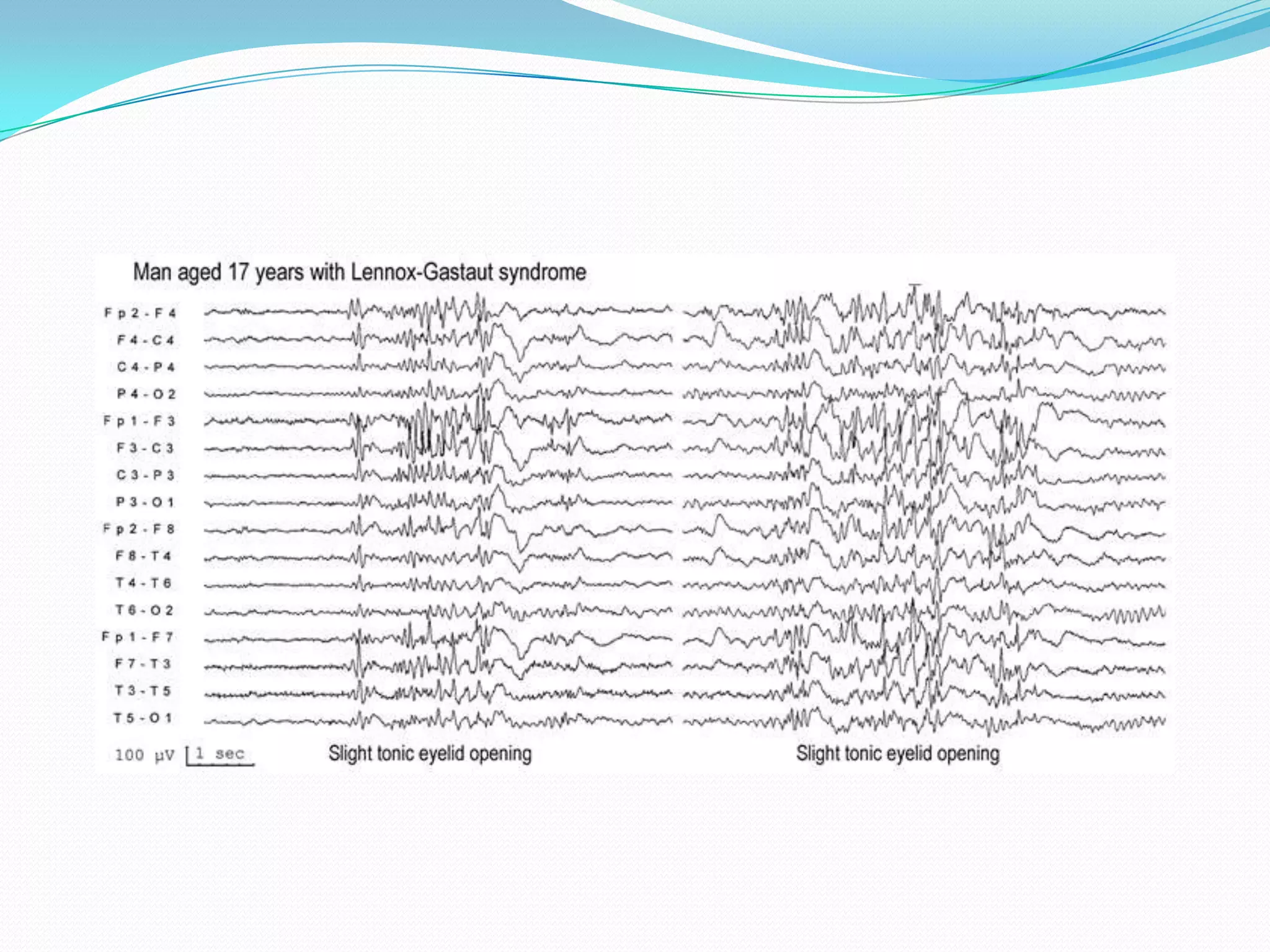Epileptic encephalopathy -EEG | PPT