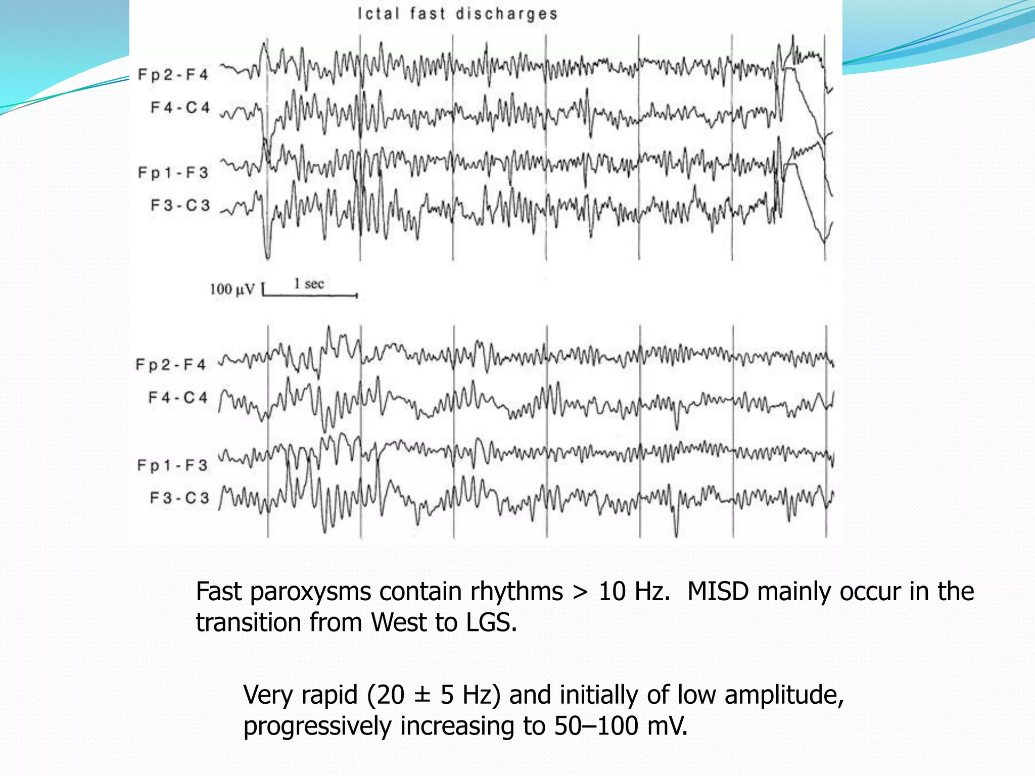Epileptic encephalopathy -EEG | PPT