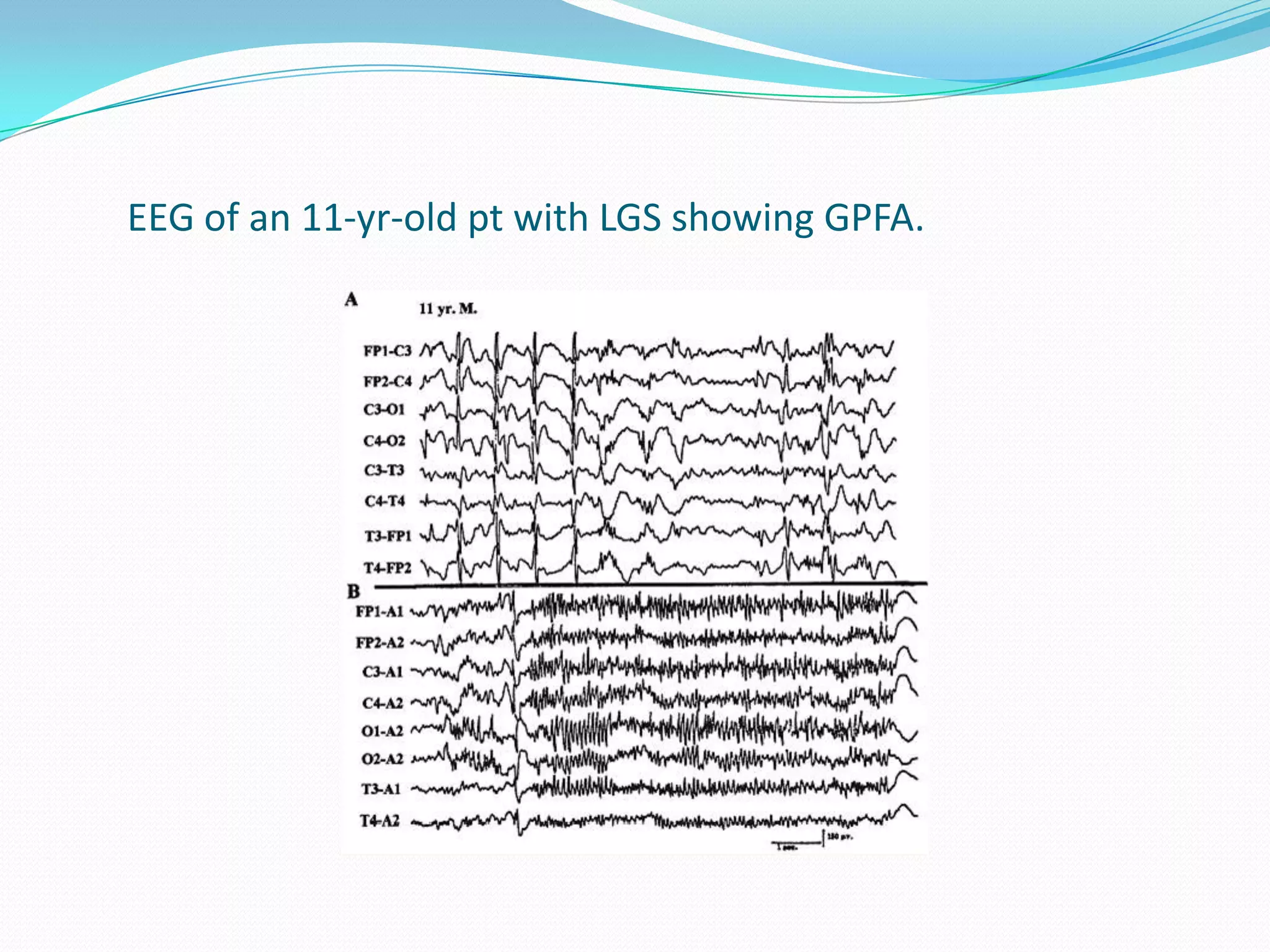 Epileptic encephalopathy -EEG | PPT