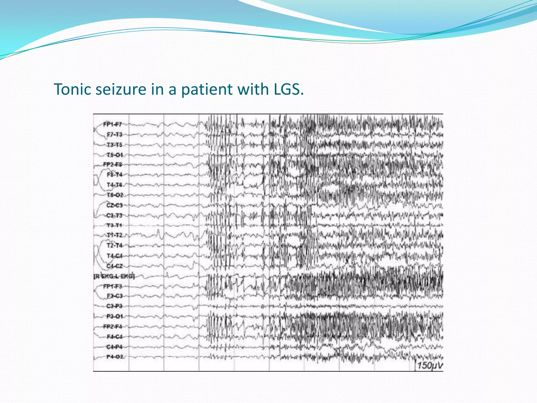 Epileptic encephalopathy -EEG | PPT