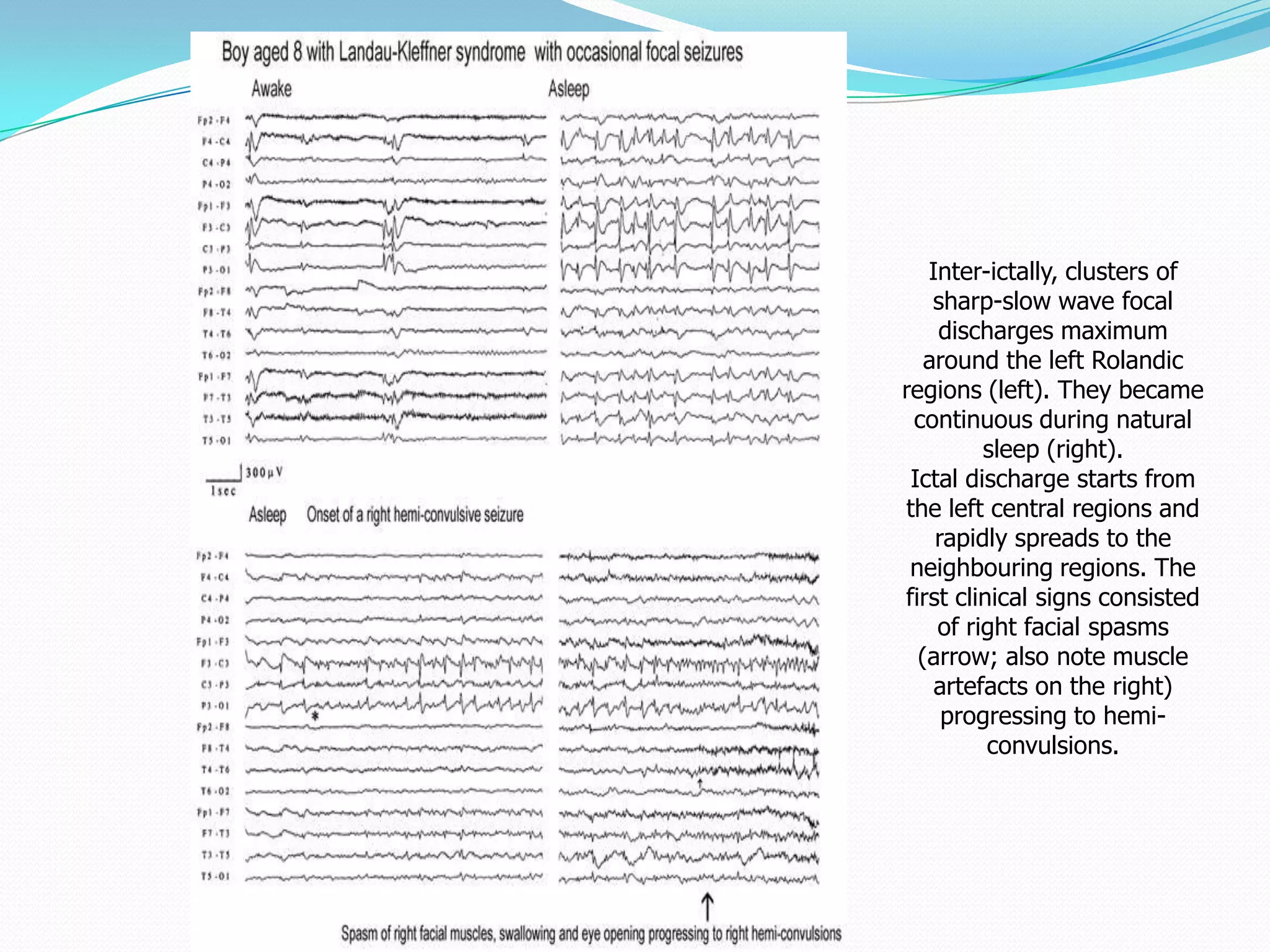 Epileptic encephalopathy -EEG | PPT
