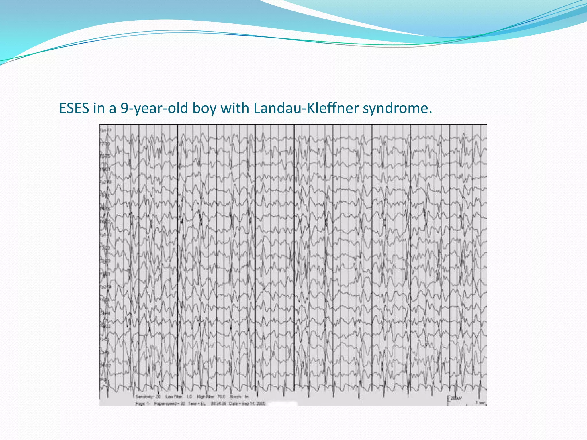 Epileptic encephalopathy -EEG | PPT