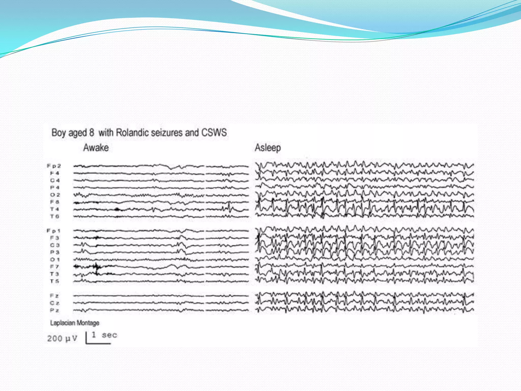 Epileptic encephalopathy -EEG | PPT