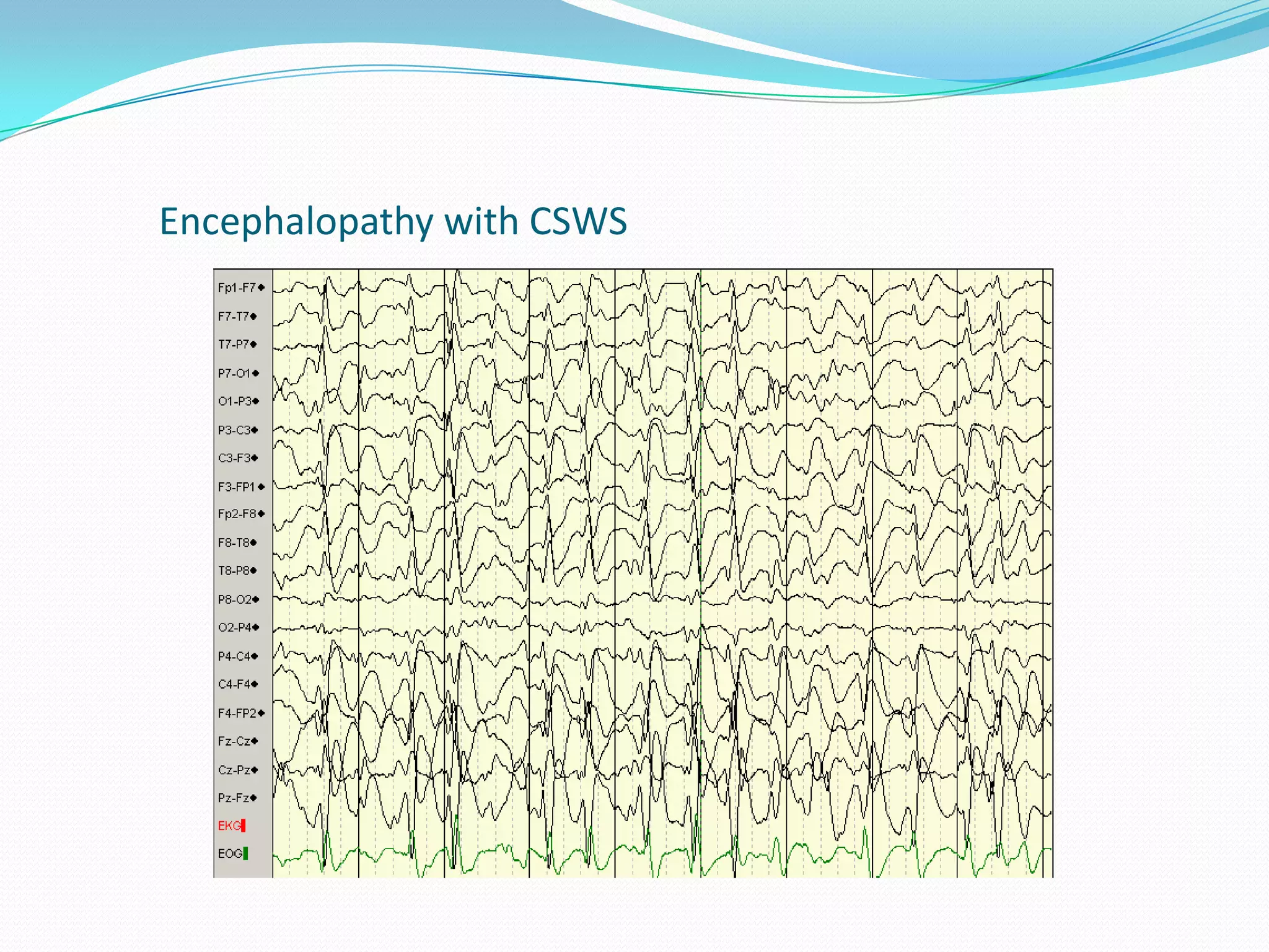 Epileptic encephalopathy -EEG | PPT