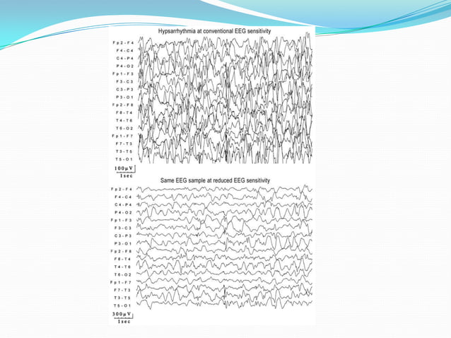 Epileptic encephalopathy -EEG | PPT