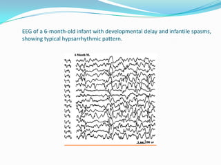 Epileptic encephalopathy -EEG | PPT