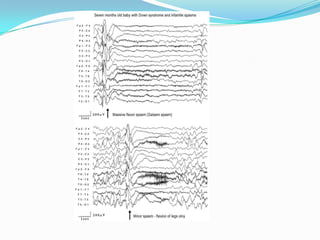 Epileptic encephalopathy -EEG | PPT
