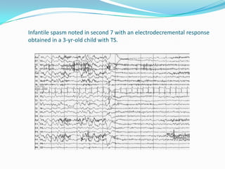 Epileptic encephalopathy -EEG | PPT