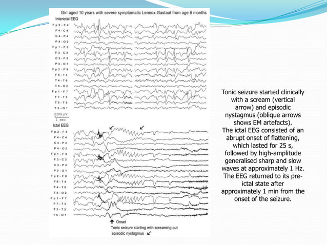 Epileptic encephalopathy -EEG | PPT