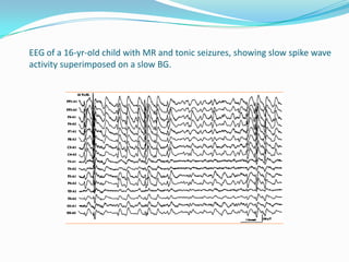 Epileptic encephalopathy -EEG | PPT
