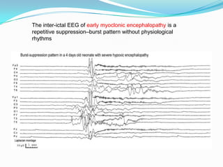 Epileptic encephalopathy -EEG | PPT
