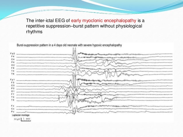 Epileptic encephalopathy -EEG