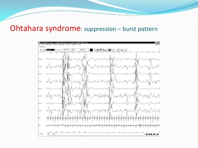 Epileptic encephalopathy -EEG
