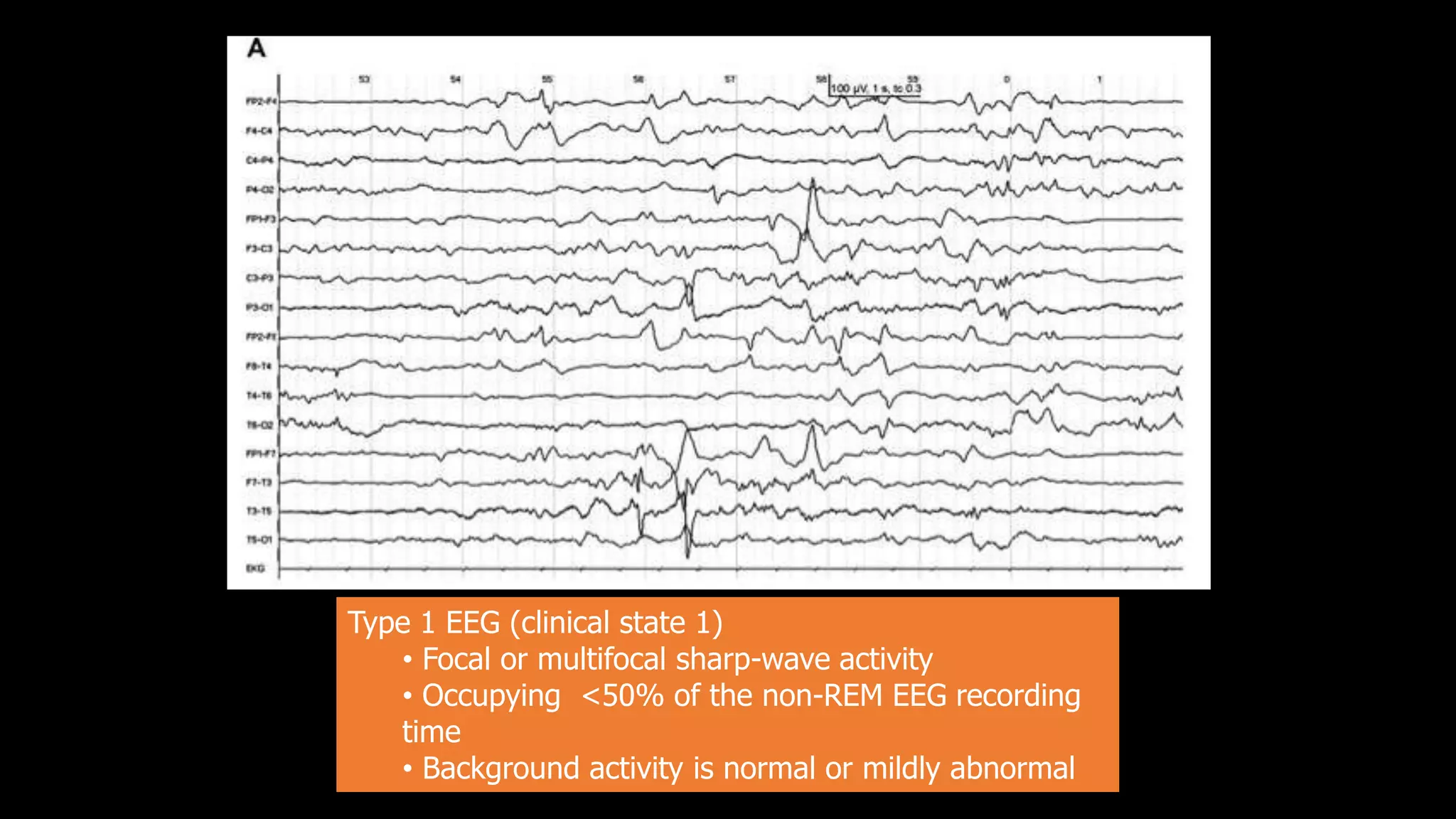 Epileptic encephalopathy | PPTX