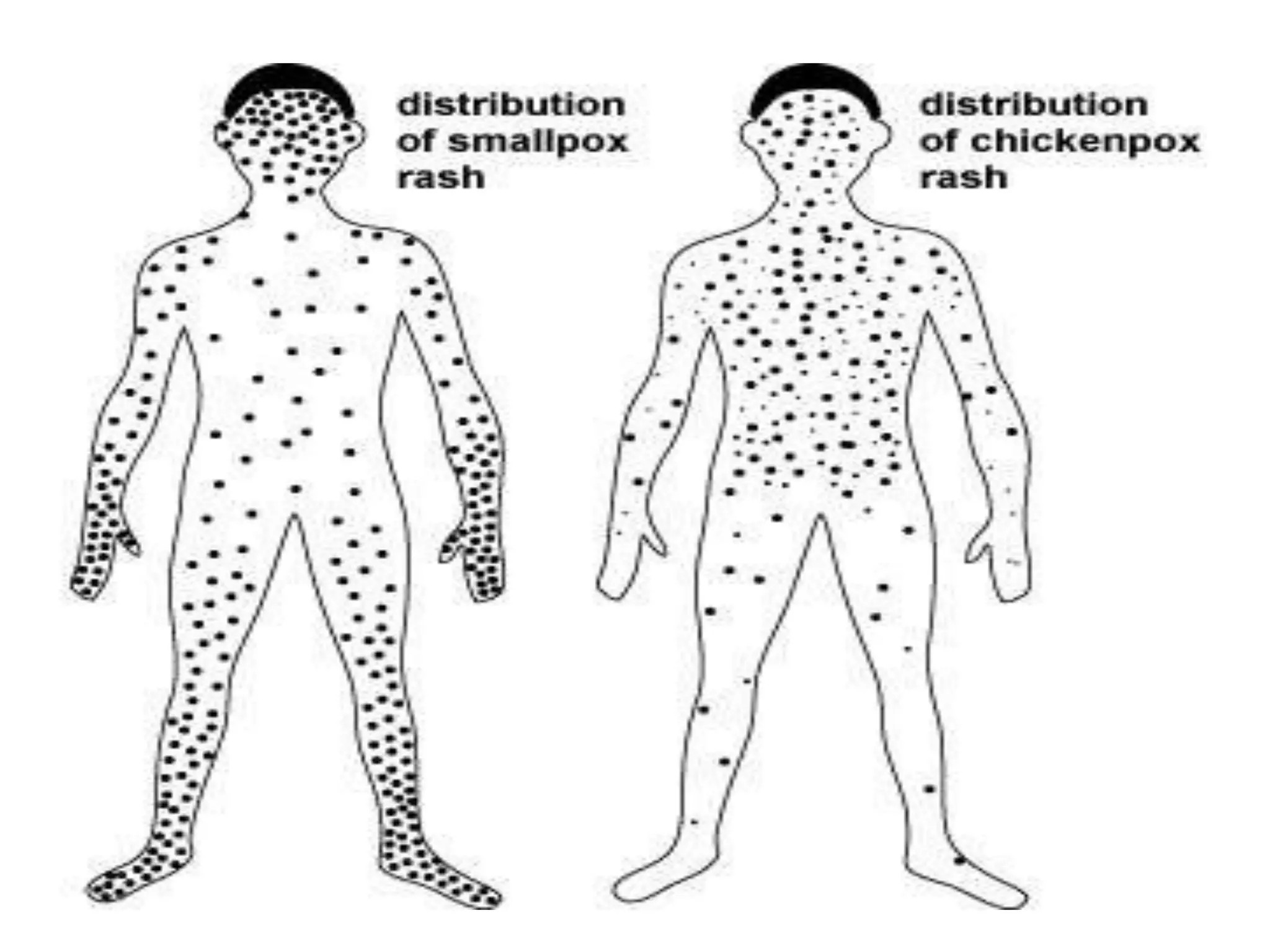 EPIDEMIOLOGY OF CHICKENPOX | PPTX