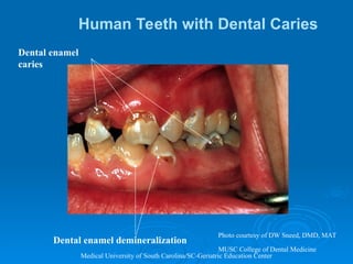 epidemiology of dental caries in older adults | PPT
