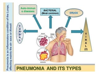 EPIDEMIOLOGY OF PNEUMONIA | PPTX