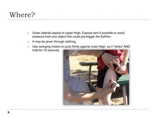 Anaphylaxis and EpiPen | PPTX