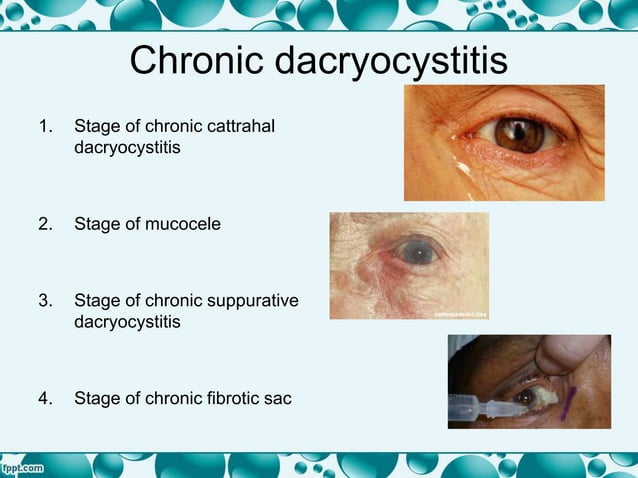 Epiphora | PPTX | Eye and Vision Conditions | Diseases and Conditions