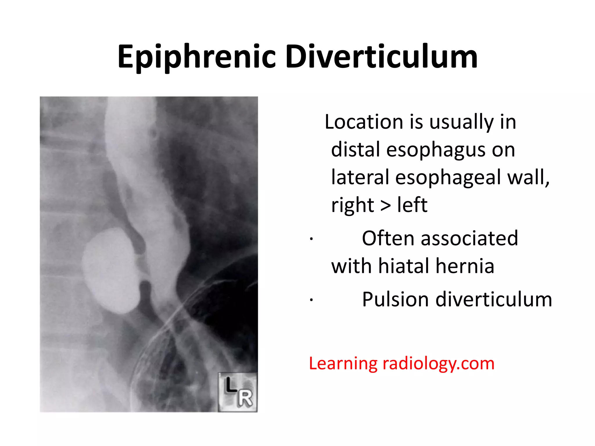 Epiphrenic diverticulum | PPTX