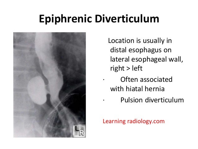 Epiphrenic diverticulum