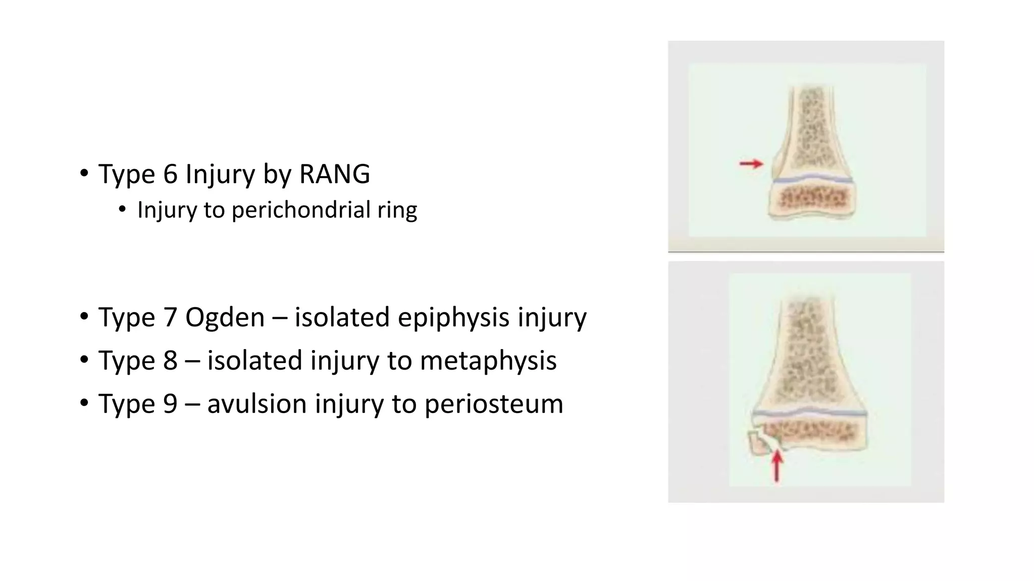 Epiphyseal injuries | PPTX