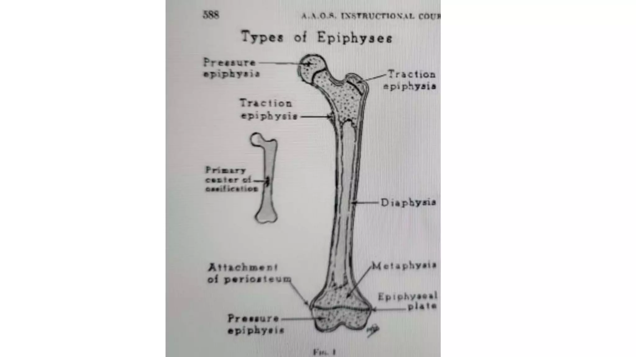 Epiphyseal injuries | PPTX
