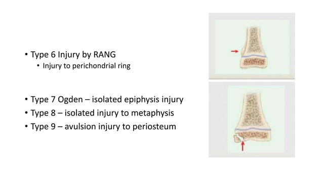 Epiphyseal injuries | PPTX
