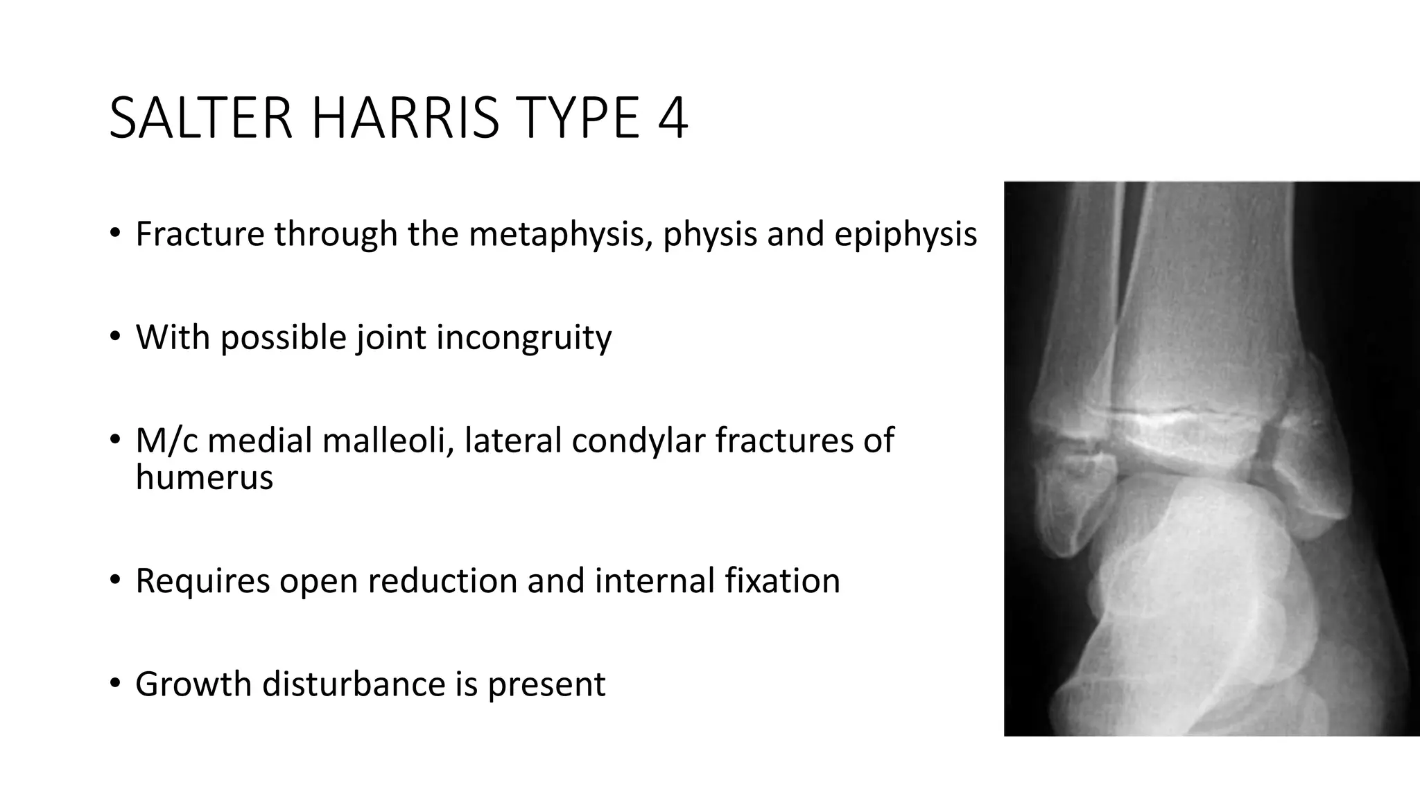 epiphyseal injuries.pptx