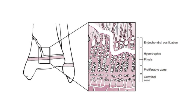 epiphyseal injuries.pptx
