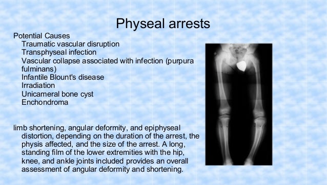 Epiphyseal injury