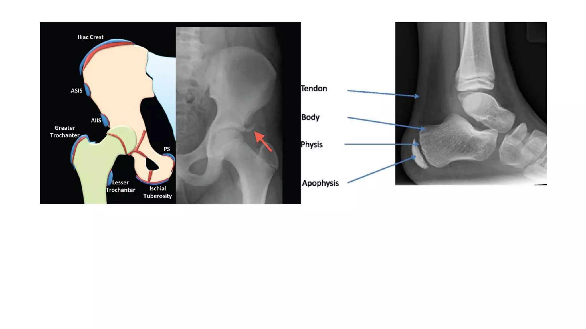 Epiphysis and apophysis | PPTX