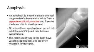 Epiphysis and apophysis | PPT