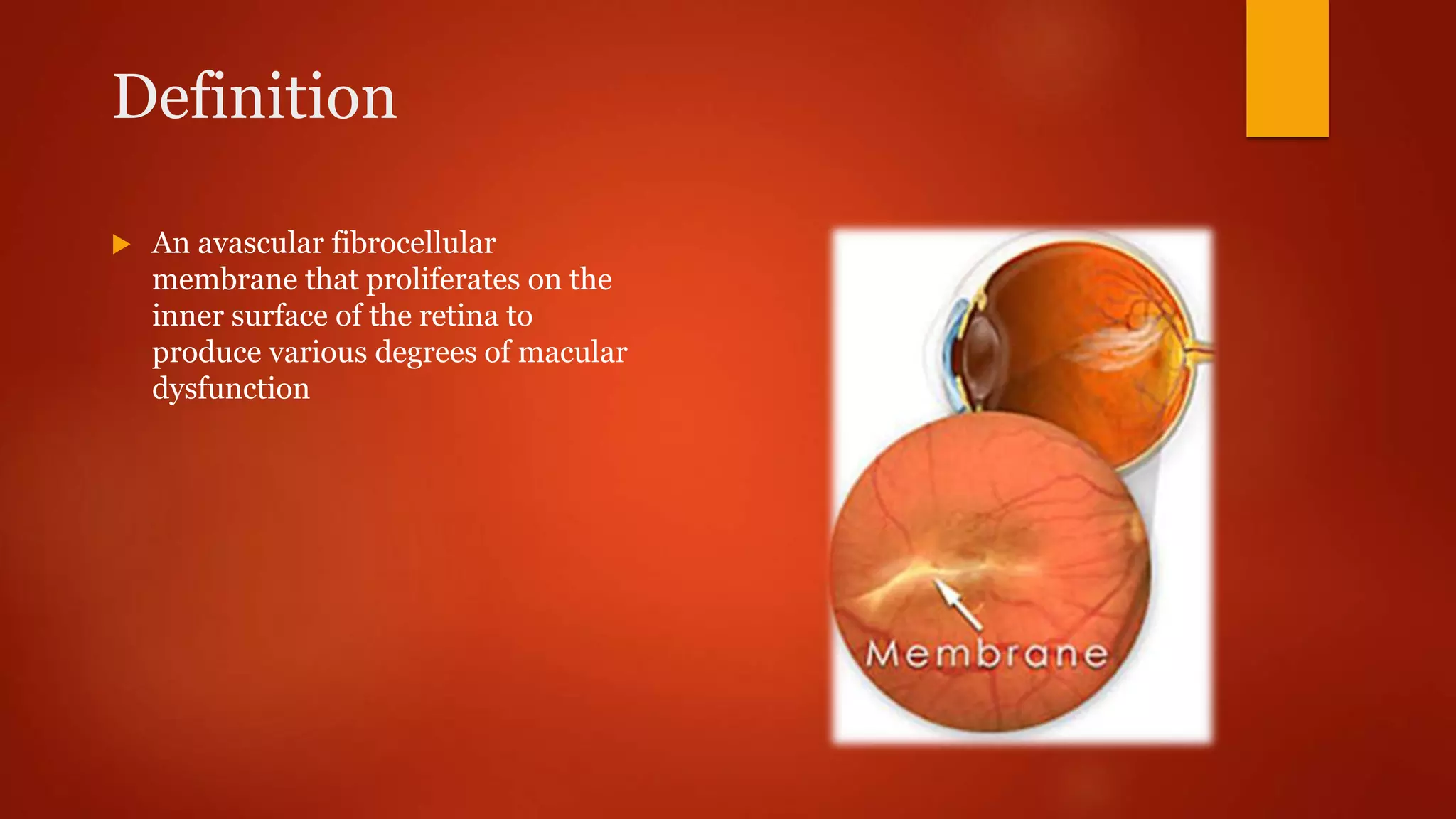Epiretinal membrane | PPTX