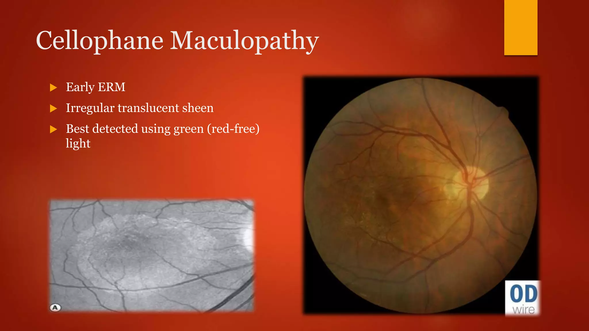 Epiretinal membrane | PPTX