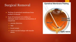 Epiretinal membrane | PPTX