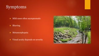 Epiretinal membrane | PPTX