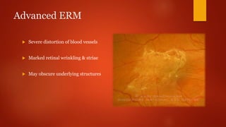 Epiretinal membrane | PPTX