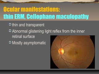 NW2010 Epiretinal membrane | PPT
