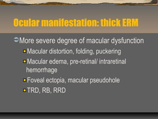 NW2010 Epiretinal membrane | PPT
