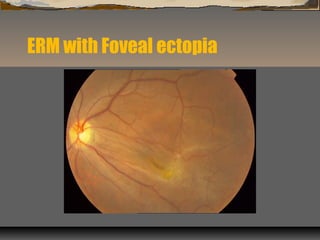 NW2010 Epiretinal membrane | PPT