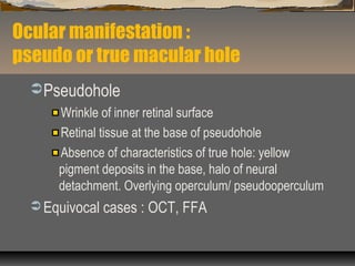 NW2010 Epiretinal membrane | PPT