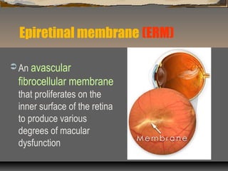NW2010 Epiretinal membrane | PPT