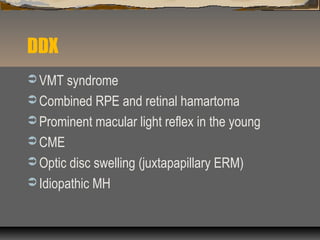 NW2010 Epiretinal membrane | PPT