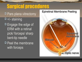 NW2010 Epiretinal membrane | PPT