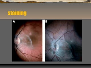 NW2010 Epiretinal membrane | PPT