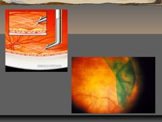 NW2010 Epiretinal membrane | PPT