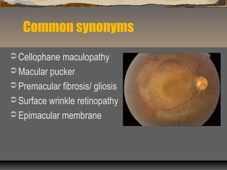 NW2010 Epiretinal membrane | PPT
