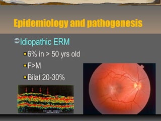 NW2010 Epiretinal membrane | PPT