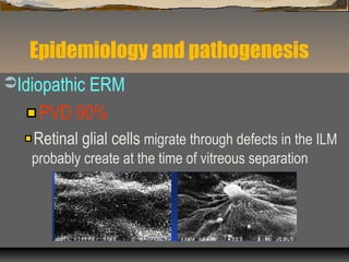 NW2010 Epiretinal membrane | PPT